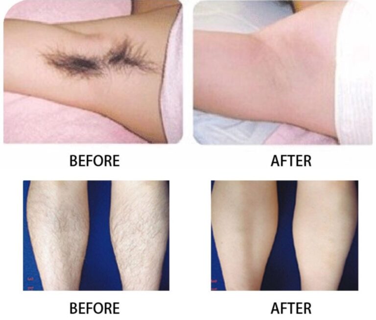 IPL Permanent Hair Reduction Treatment – Advanced Health And Beauty